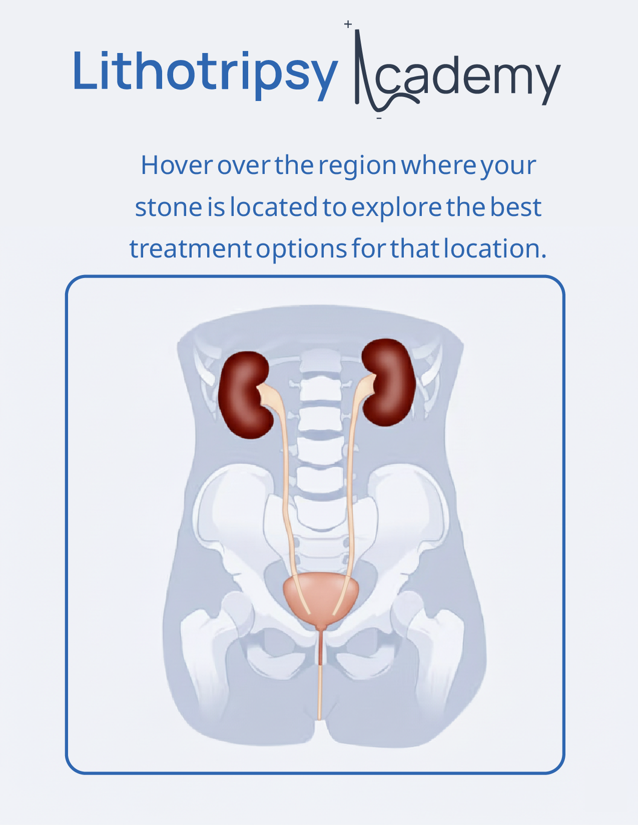 About shockwave lithotripsy – Lithotripsy Academy